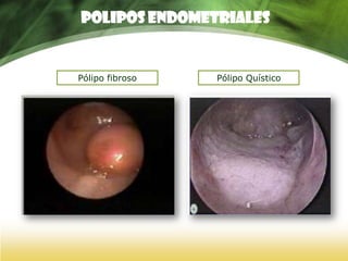 Polipos endometriales | PPTX