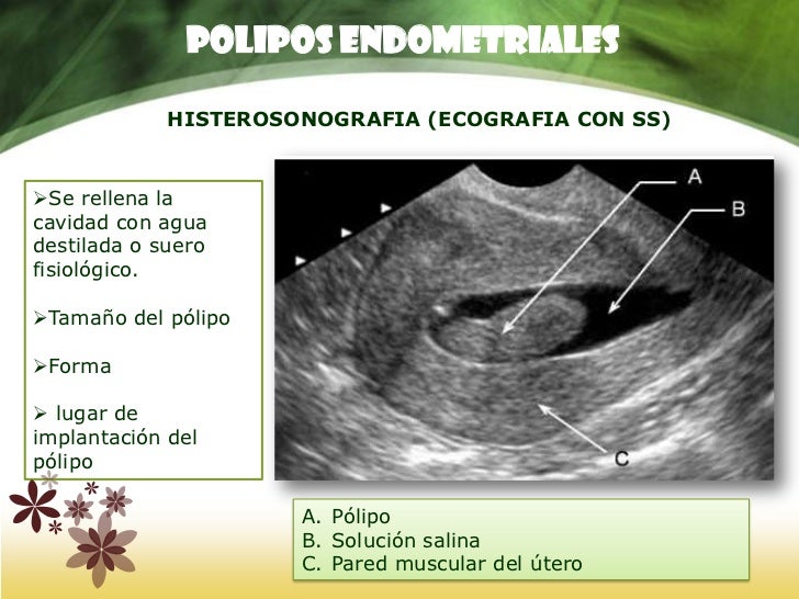 Polipos endometriales