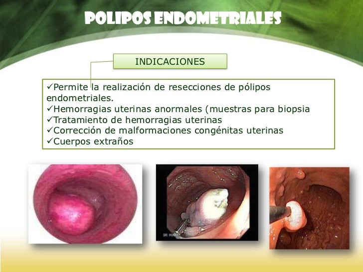 Polipos endometriales