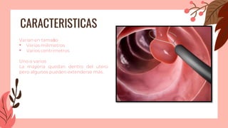 Polipos endometriales e hiperplasia | PPTX