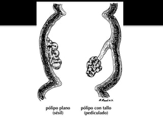 Polipos intestinales | PPTX