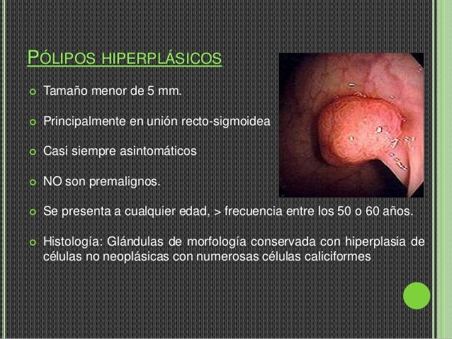 Poliposis intestinal