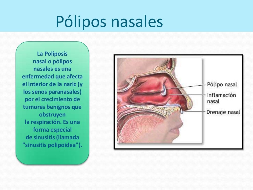 Polipos nasales