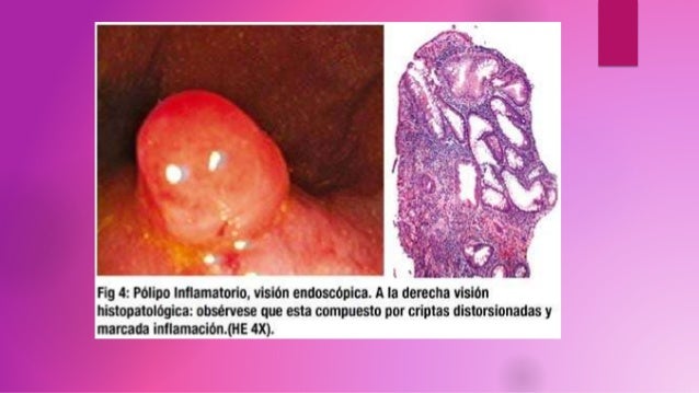 Polipos poliposis adenocarcinoma y carcinoide intestinal
