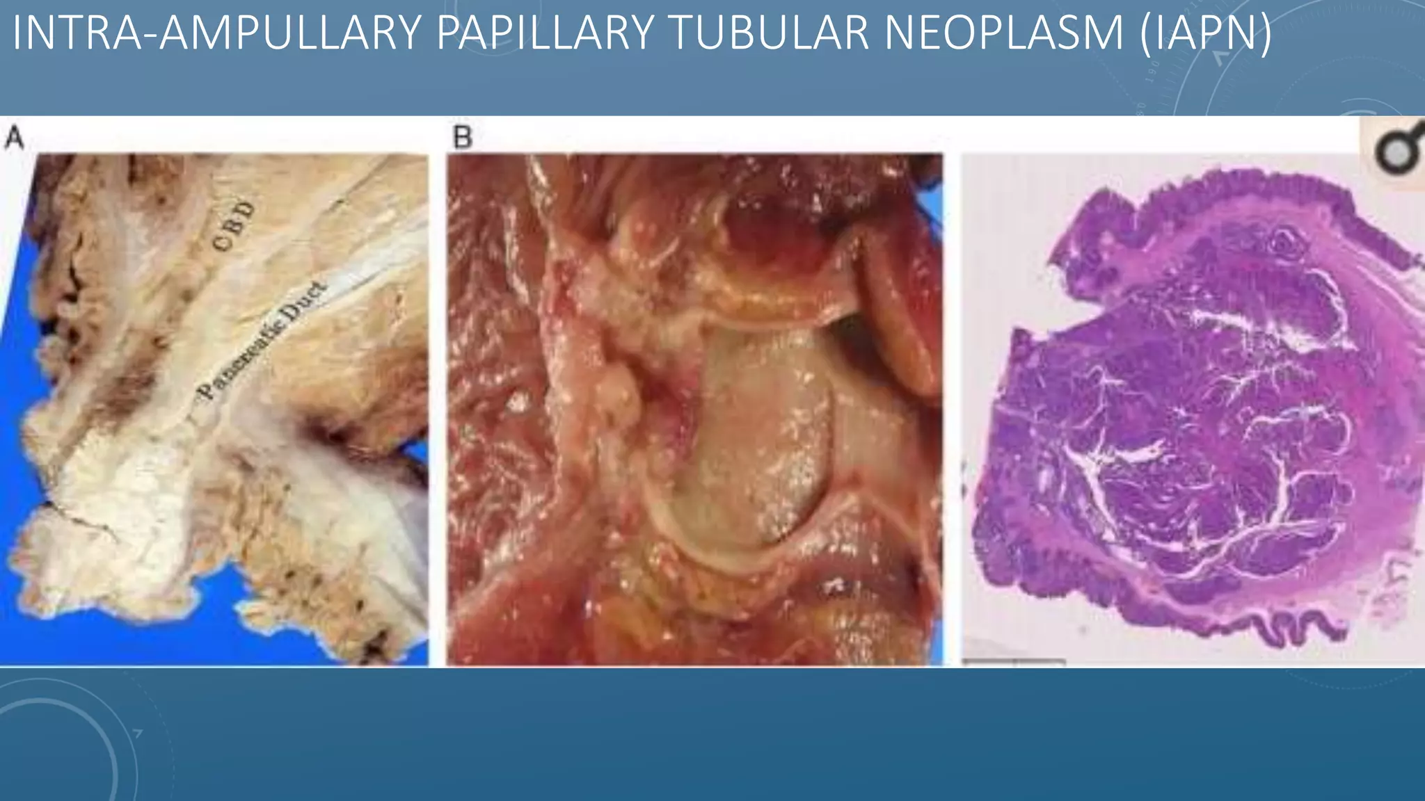 Polip pada Usus Halus.pptx
