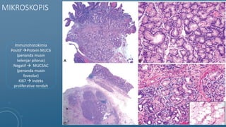 Polip pada Usus Halus.pptx