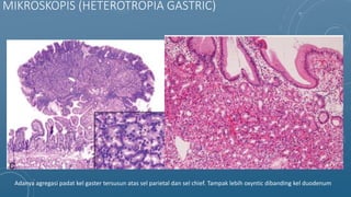 Polip pada Usus Halus.pptx