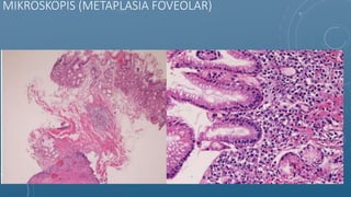 Polip pada Usus Halus.pptx