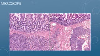 Polip pada Usus Halus.pptx