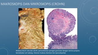 Polip pada Usus Halus.pptx