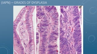 Polip pada Usus Halus.pptx