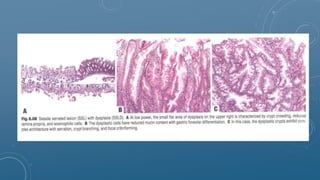 Polip pada Usus Halus.pptx