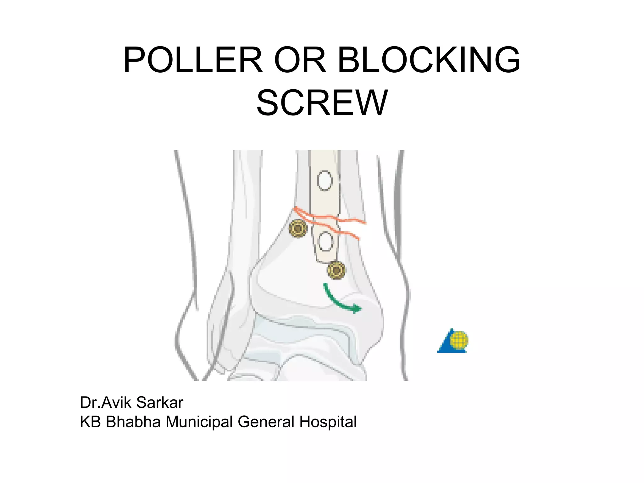 Poller or blocking screw | PPT