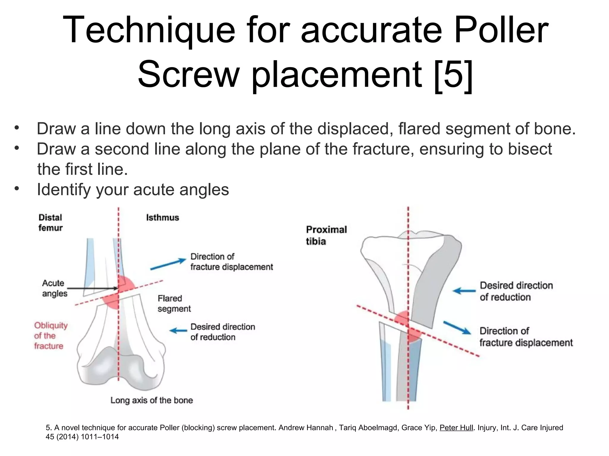 Poller or blocking screw | PPT