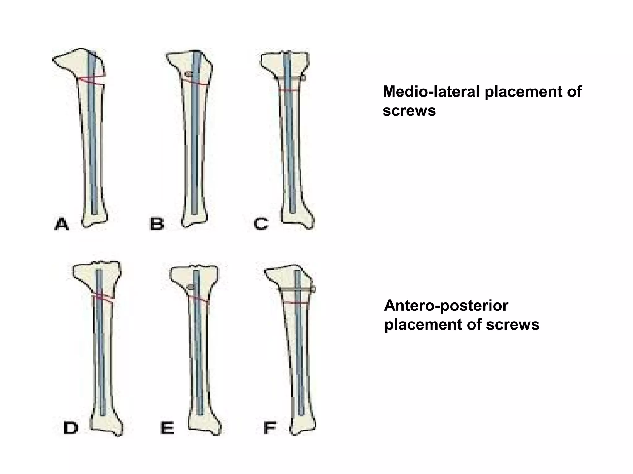 Poller or blocking screw | PPT