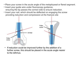 Poller or blocking screw | PPT
