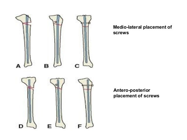 Poller or blocking screw