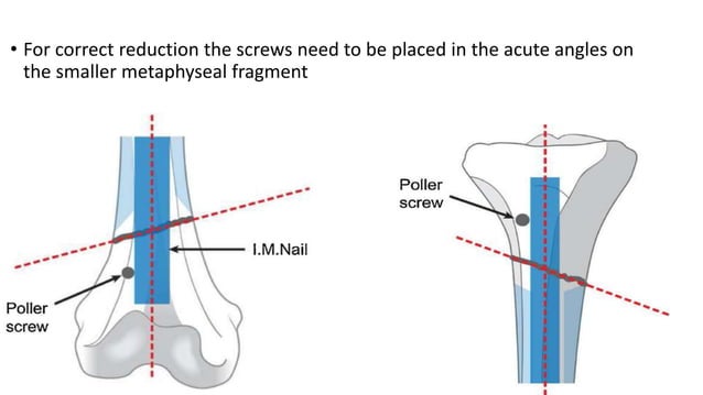 Poller screw | PPTX
