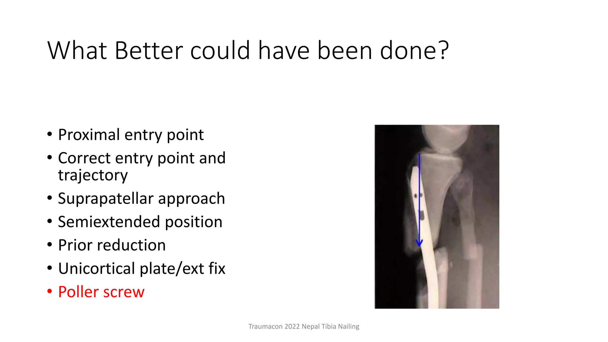 Poller screw Tibia.pptx