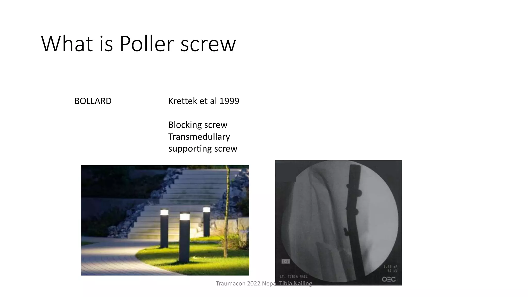 Poller screw Tibia.pptx