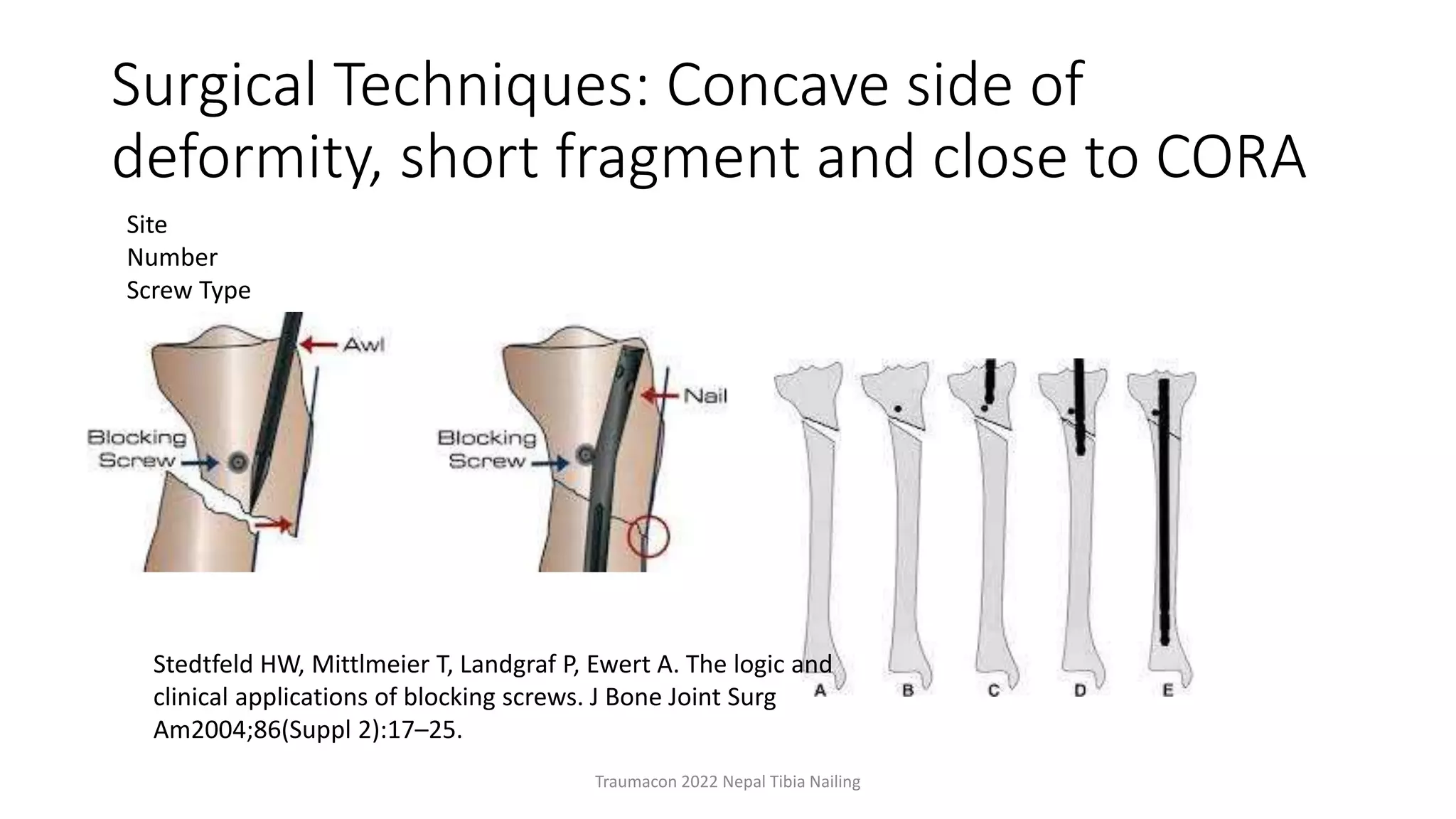 Poller screw Tibia.pptx