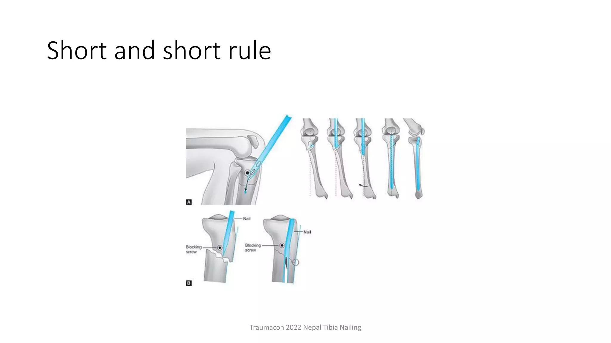 Poller screw Tibia.pptx