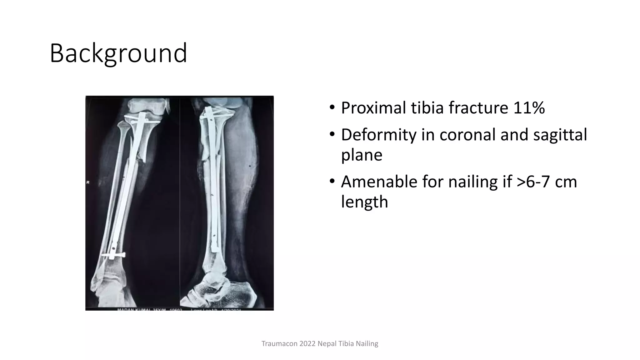 Poller screw Tibia.pptx