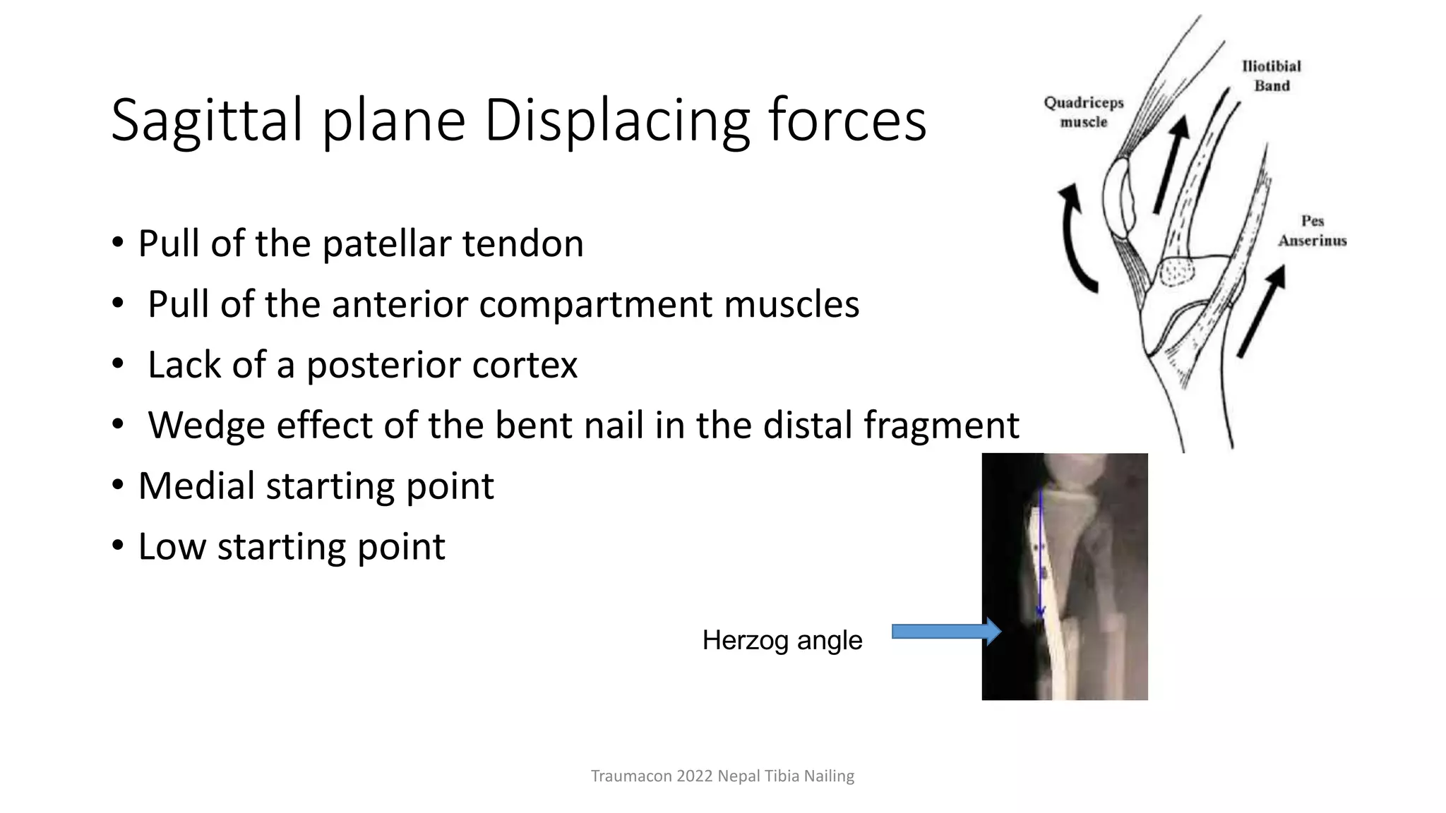 Poller screw Tibia.pptx