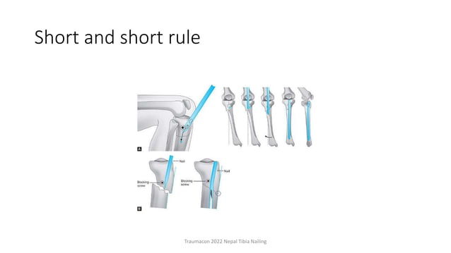 Poller screw Tibia.pptx
