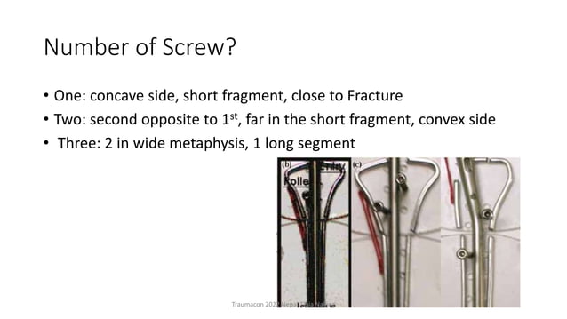 Poller screw Tibia.pptx