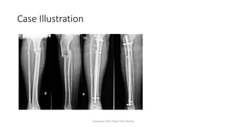 Poller screw Tibia.pptx