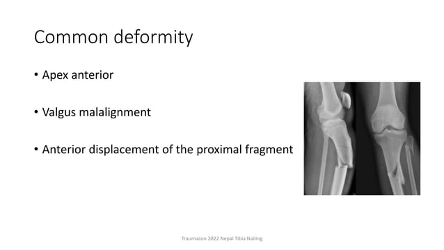 Poller screw Tibia.pptx
