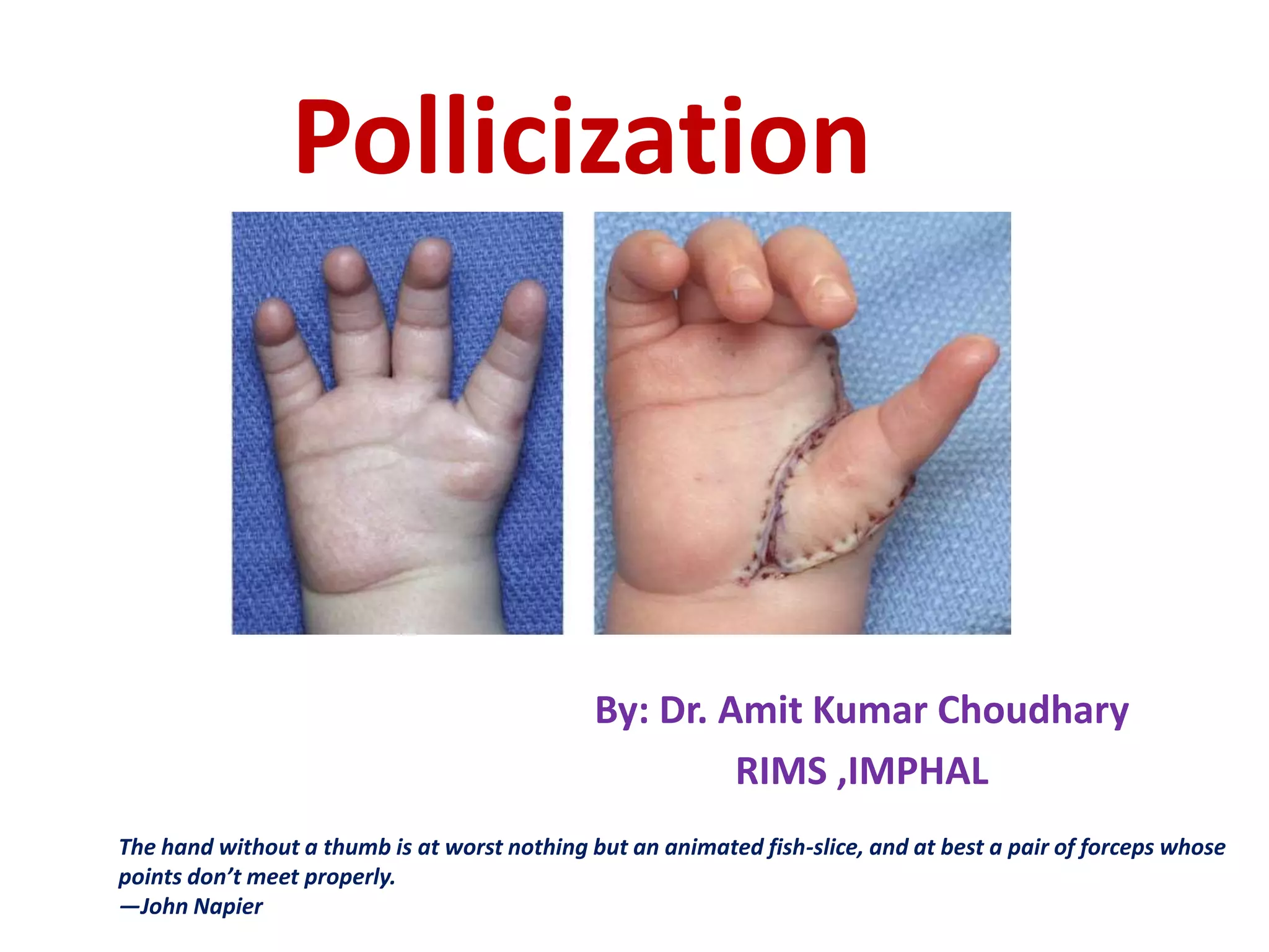 Pollicization | PPTX