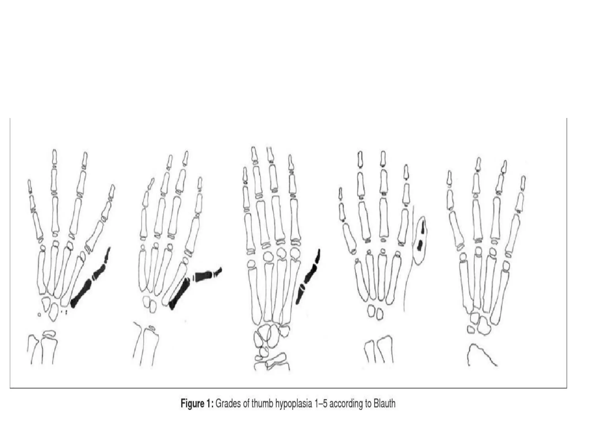 Pollicization | PPTX