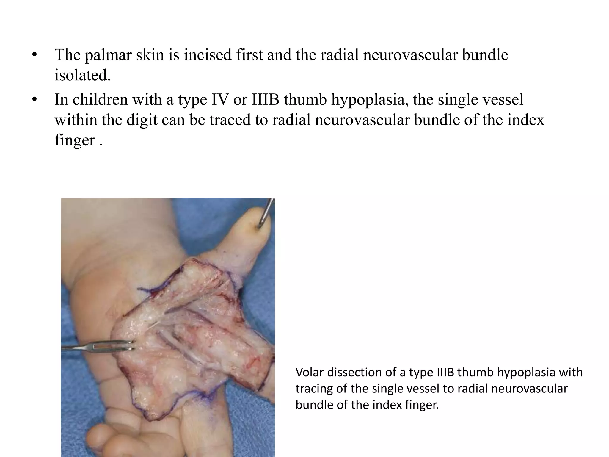 Pollicization | PPTX