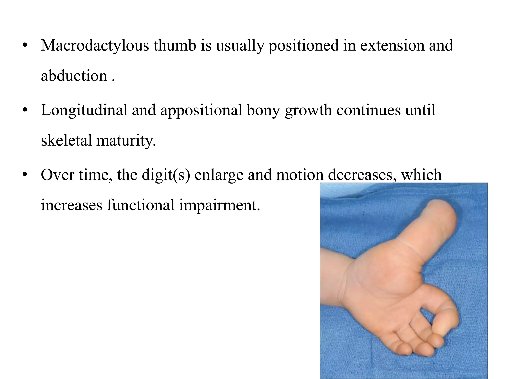 Pollicization | PPTX