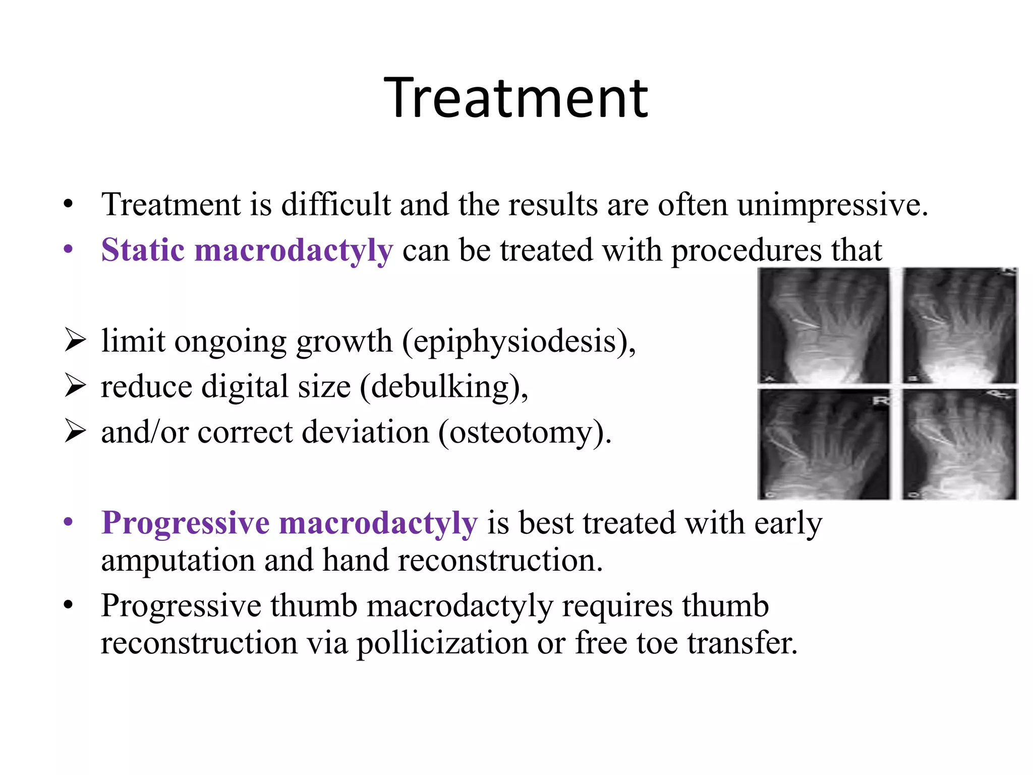Pollicization | PPTX