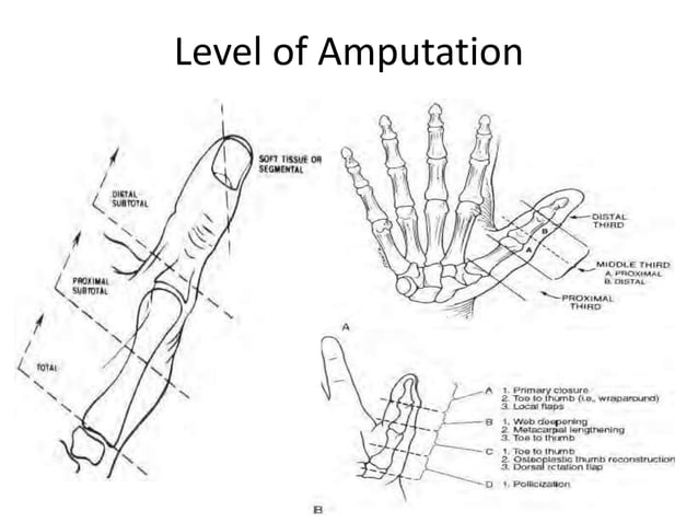 Pollicization | PPTX