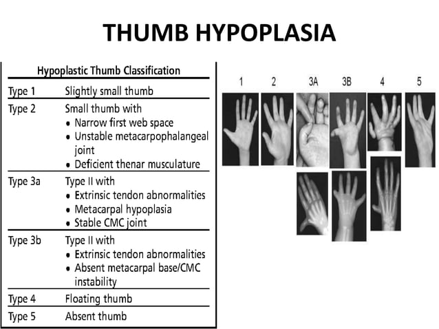 Pollicization | PPTX