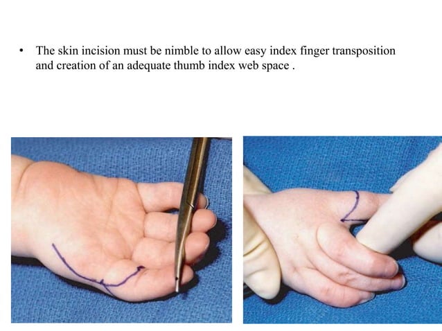 Pollicization | PPTX