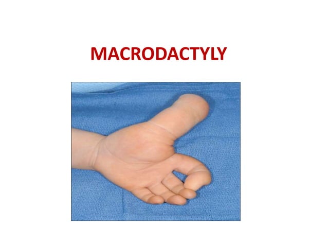 Pollicization | PPTX