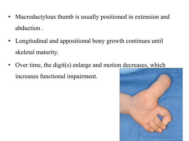Pollicization | PPTX
