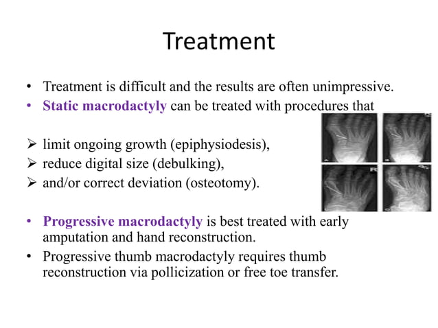 Pollicization | PPTX