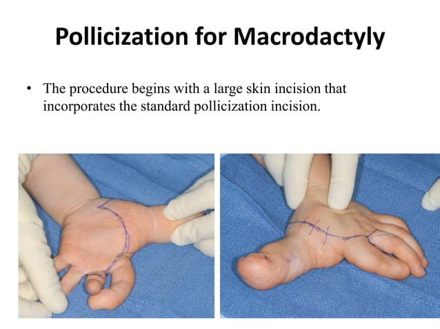 Pollicization | PPTX