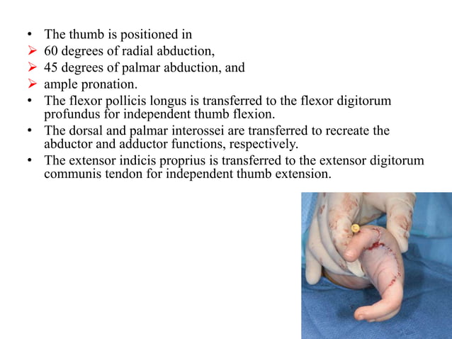Pollicization | PPTX