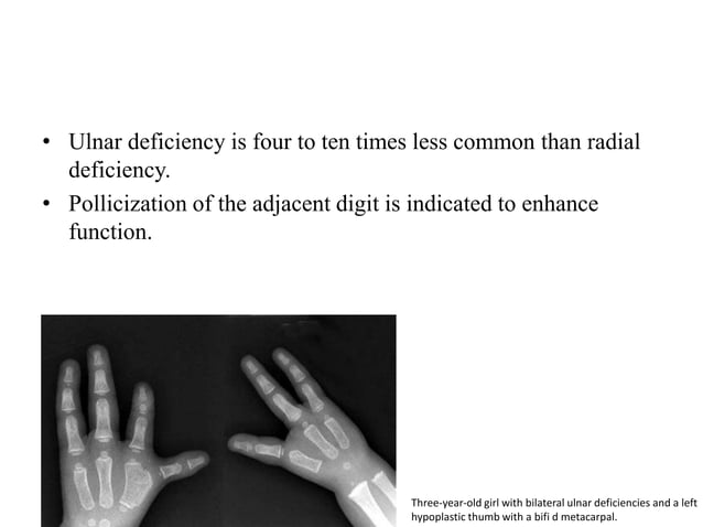 Pollicization | PPTX