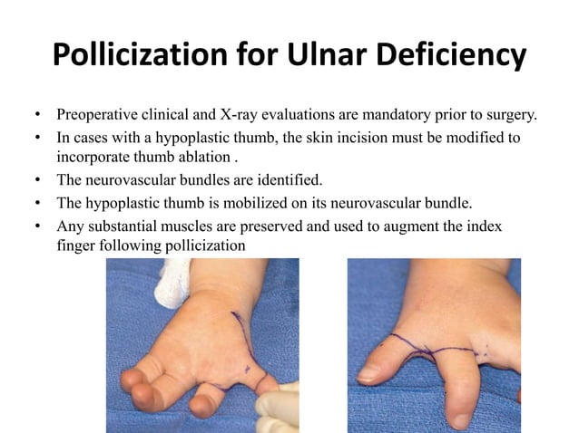Pollicization | PPTX