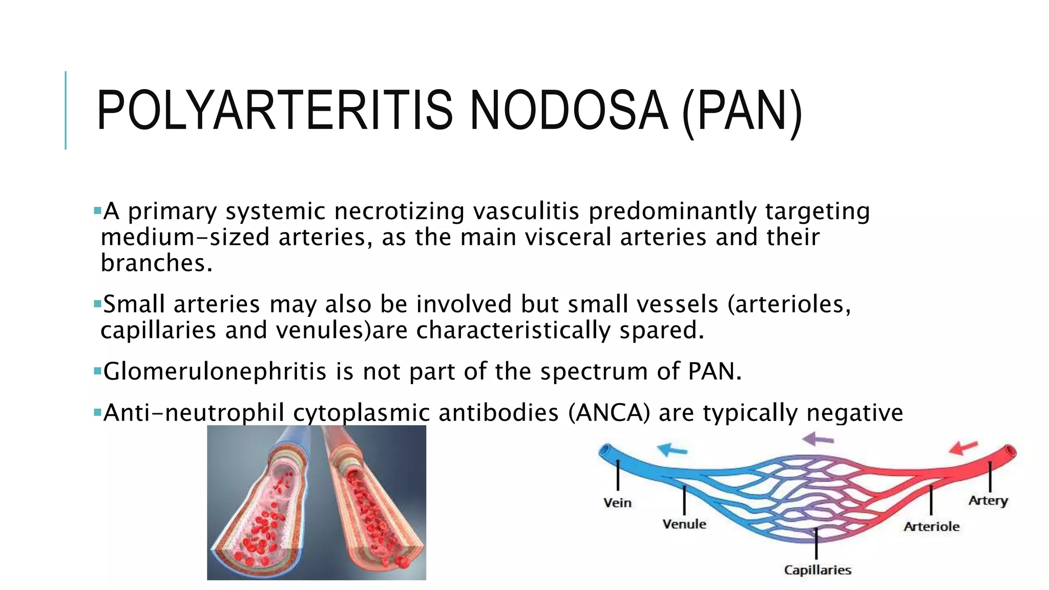 Polyarteritis nodasa and microscopic polyangitis | PPTX
