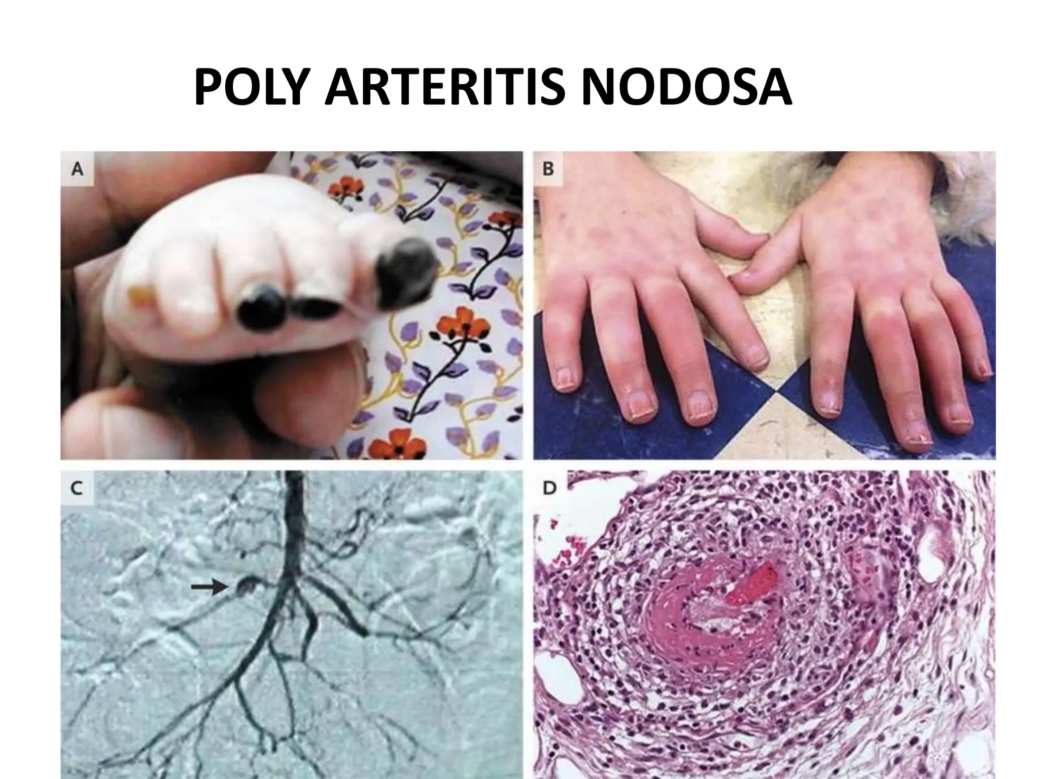 POLY ARTERITIS NODOSA POLY ARTERITIS NODOSA | PPTX