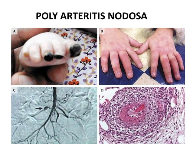 POLY ARTERITIS NODOSA POLY ARTERITIS NODOSA | PPT